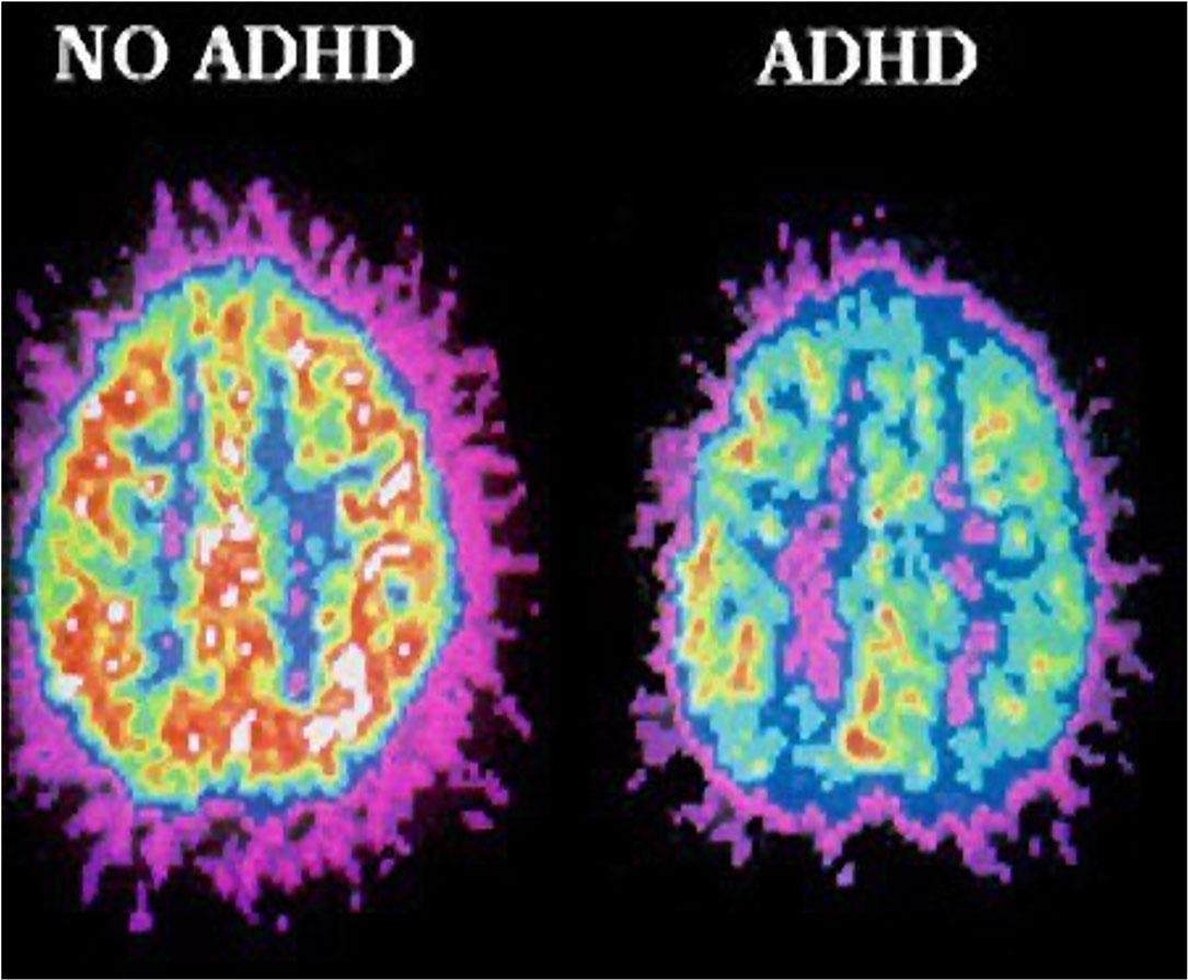 About ADHD | Adult ADHD Centre